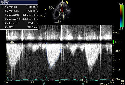 Apical 5 | Echocardiographer.or